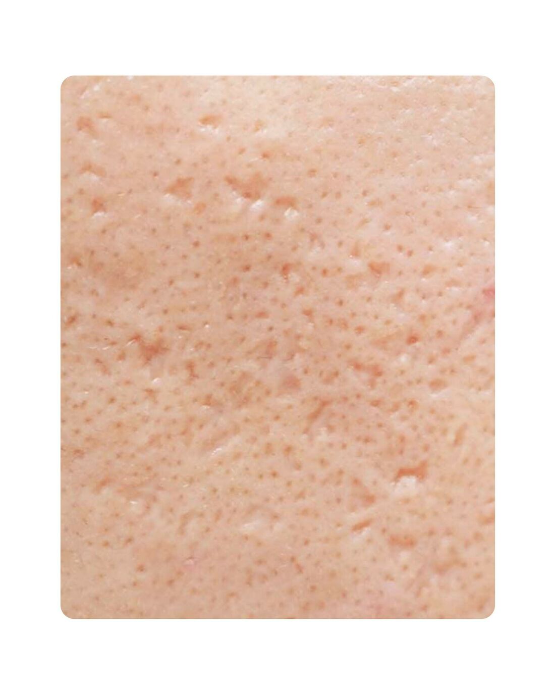 (Acne) littekens | YESS Huidtherapie