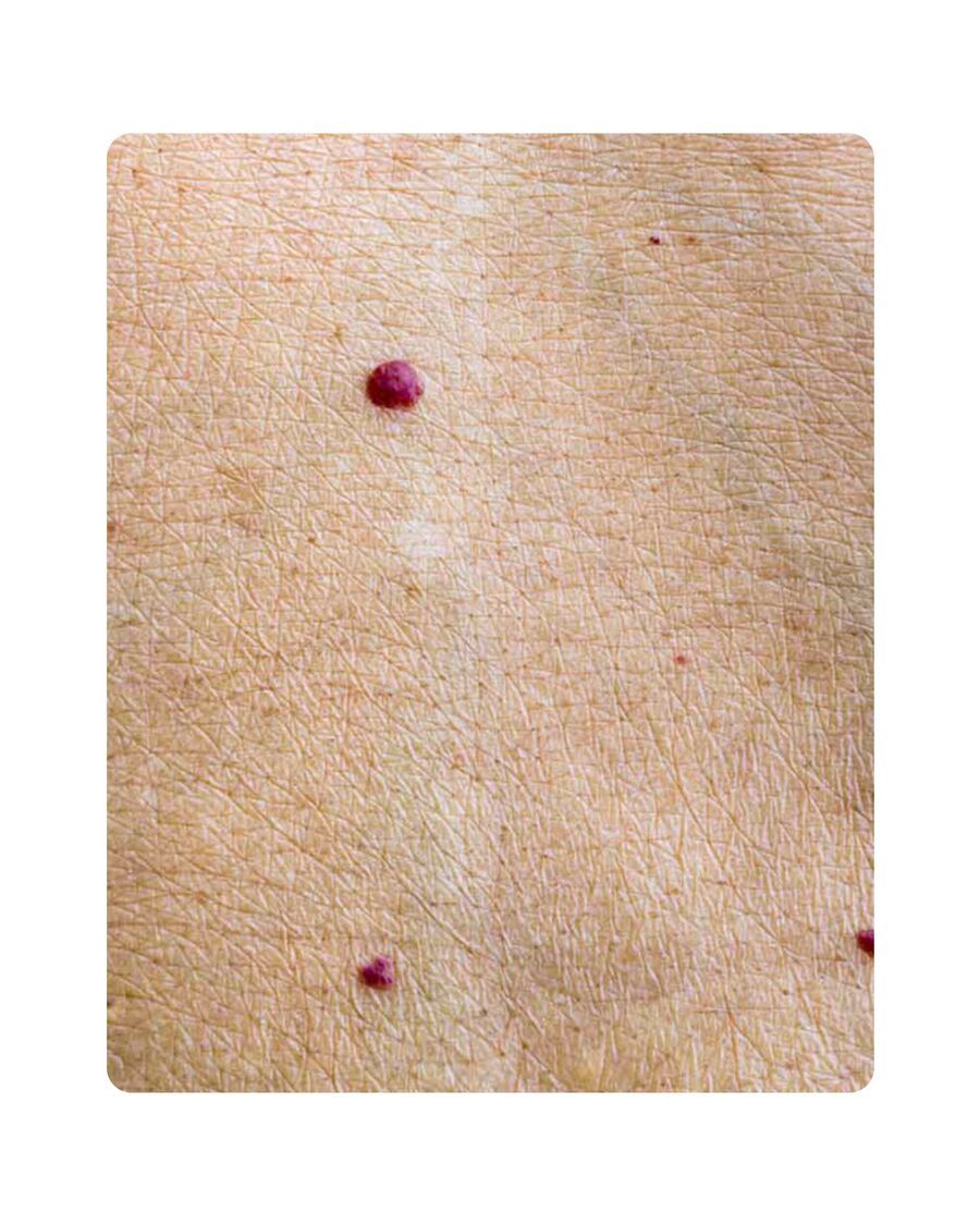 Angioma senilis | YESS Huidtherapie