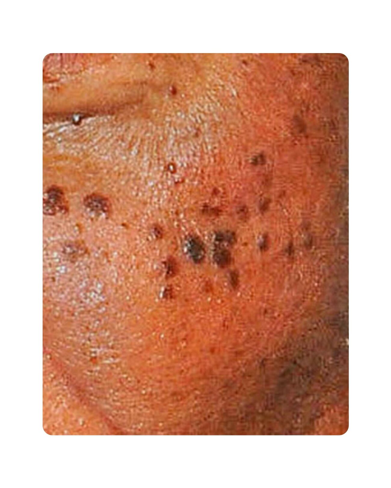 Dermatosis papulosa nigra | YESS Huidtherapie