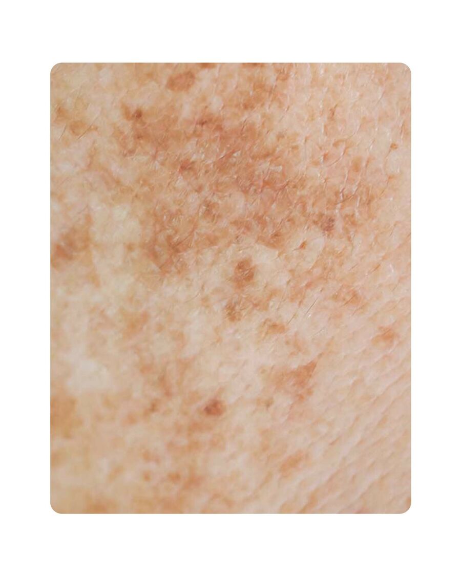 Melasma | YESS Huidtherapie