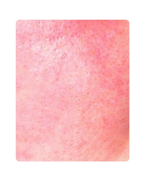 Roodheid | YESS Huidtherapie